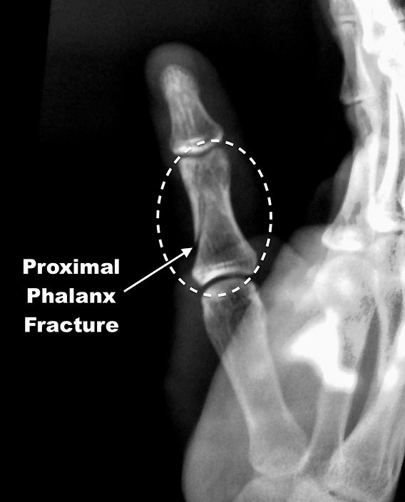 broken thumb bone x ray