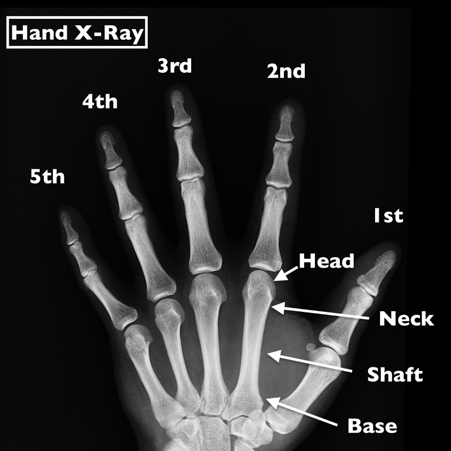 Surgical Indications and Treatment of a Metacarpal Fracture