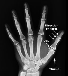 Unraveling the UCL Injury of the Thumb