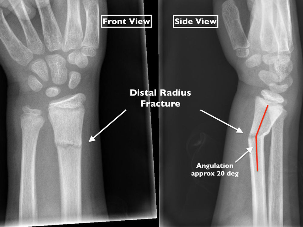 What Makes a Pediatric Wrist Fracture Different?