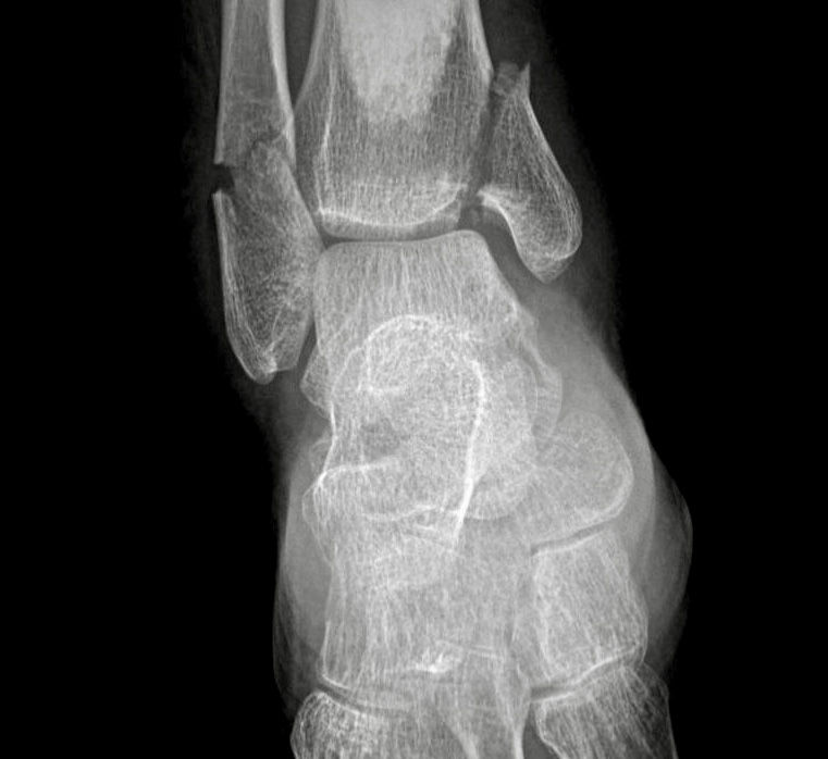 Dak Prescott - Ankle Dislocation & Fracture