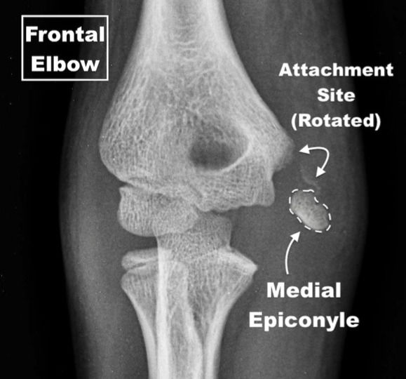 Medial Epicondyle Fractures in Young Athletes