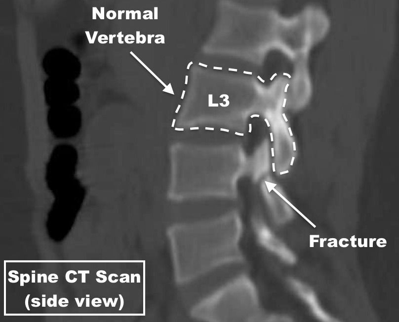Stress Fracture of the Spine (Spondylolysis)