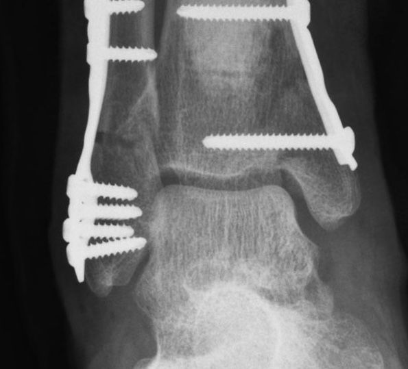 Gordon Hayward - The Injury, Surgery and Recovery