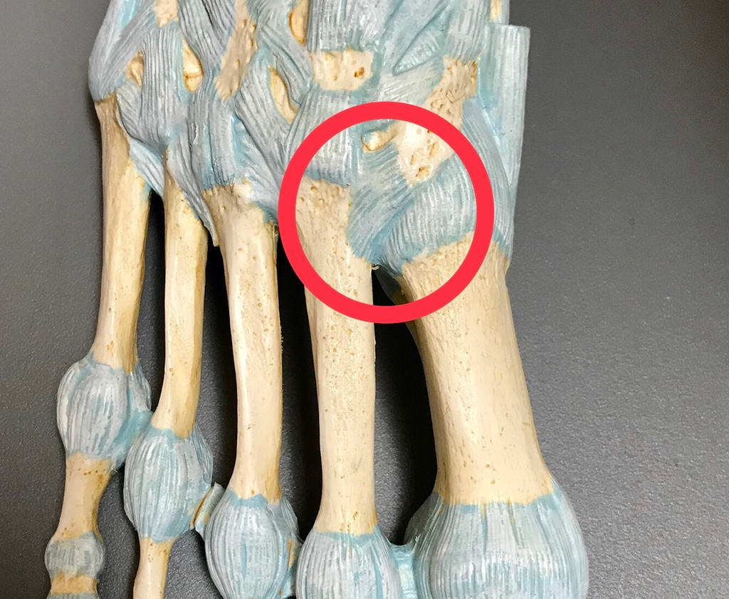 Unraveling the UCL Injury of the Thumb