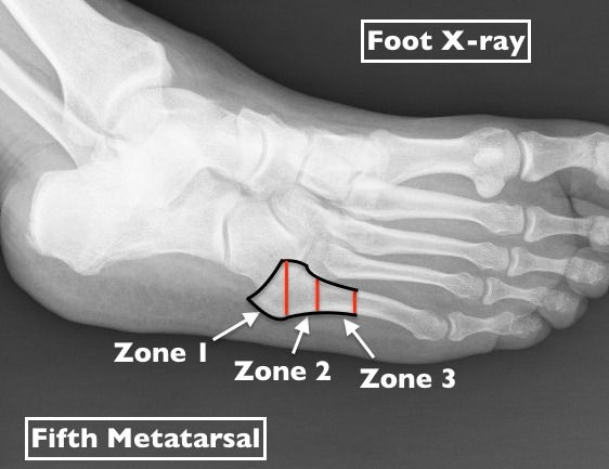 What Exactly is a Jones Fracture (Foot) and Why Might it Need Surgery?