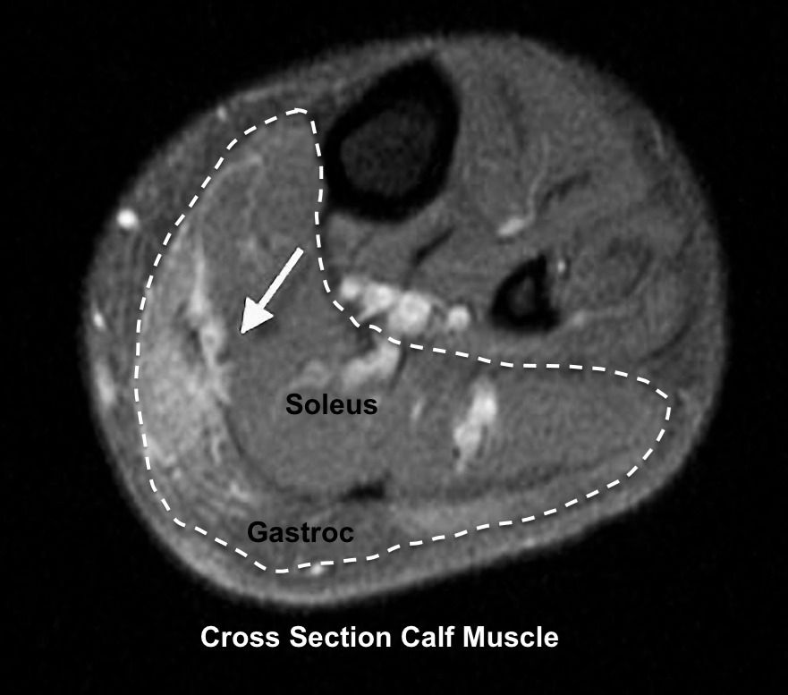 KD's Injury is a Classic Calf Tear