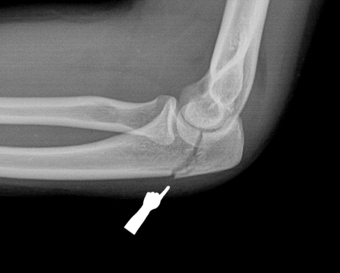 broken bone above elbow