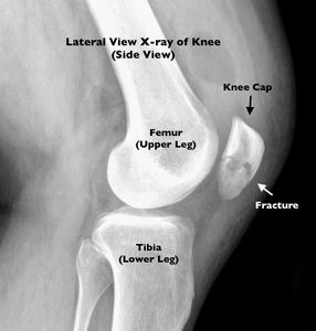 Patella (Knee Cap) Fracture