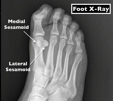 Could Your Nagging Foot Pain Be Sesamoiditis?
