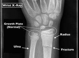 What Makes a Pediatric Wrist Fracture Different?