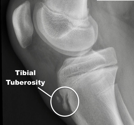 Osgood-Schlatter's Disease (Knee)