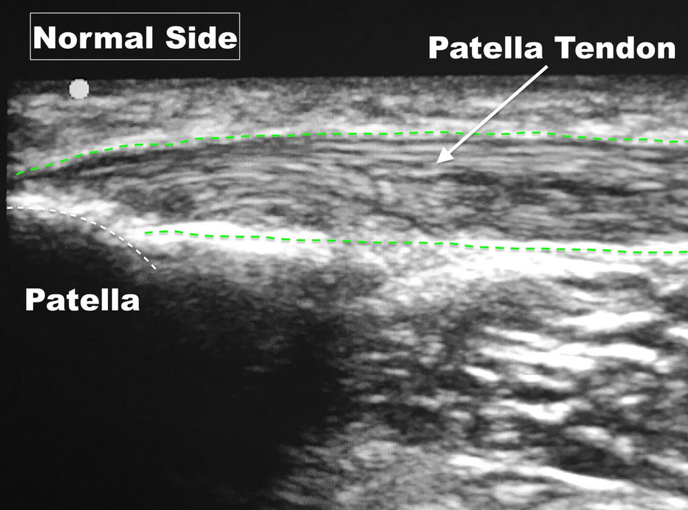 Chronic Patella Tendinopathy