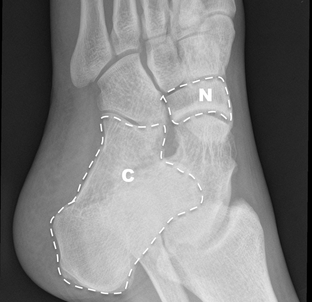 Tarsal Coalition - A Rare Find
