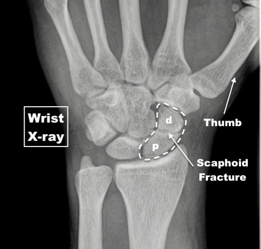 Scaphoid Fracture Mechanism Of Injury And Treatment Arthroscopic