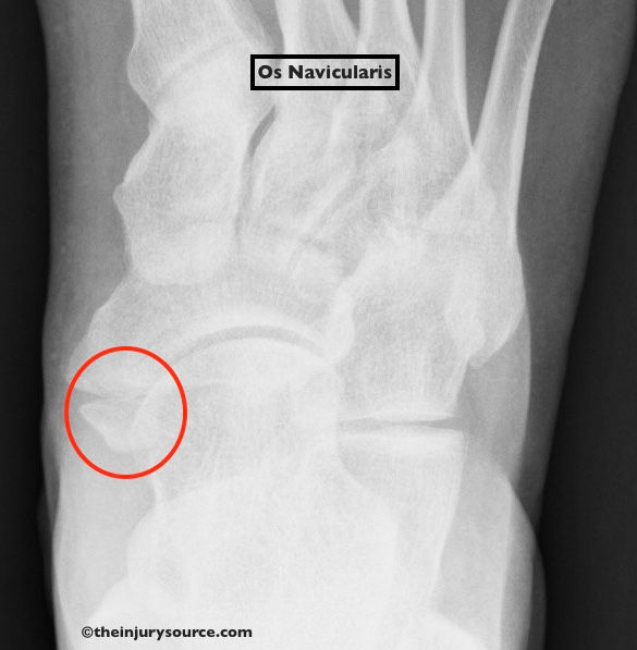 Os Navicularis (Accessory Navicular)