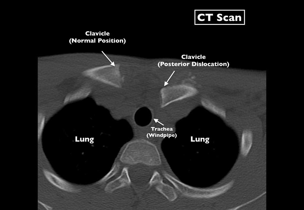 Sternoclavicular Injuries and Why They Can Be Dangerous