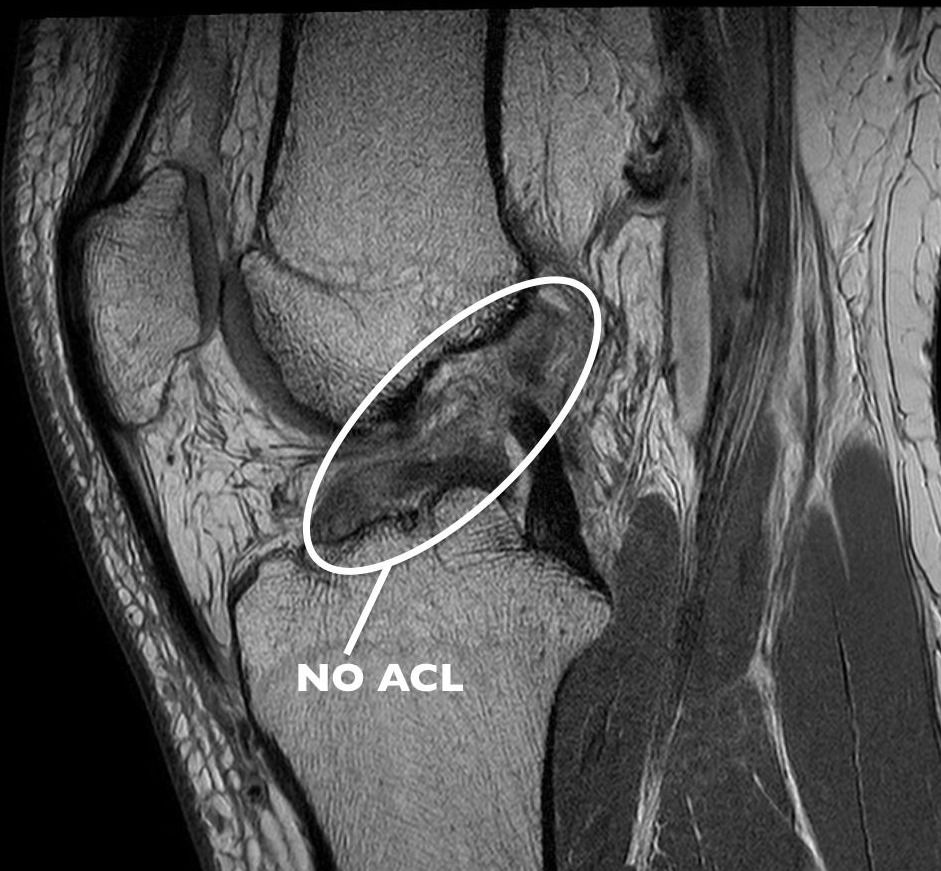 Basic MRI Evaluation Of An ACL Tear Basic MRI Evaluation Of An ACL Tear