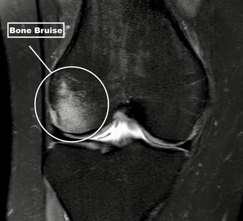 What Exactly Is A Bone Bruise 