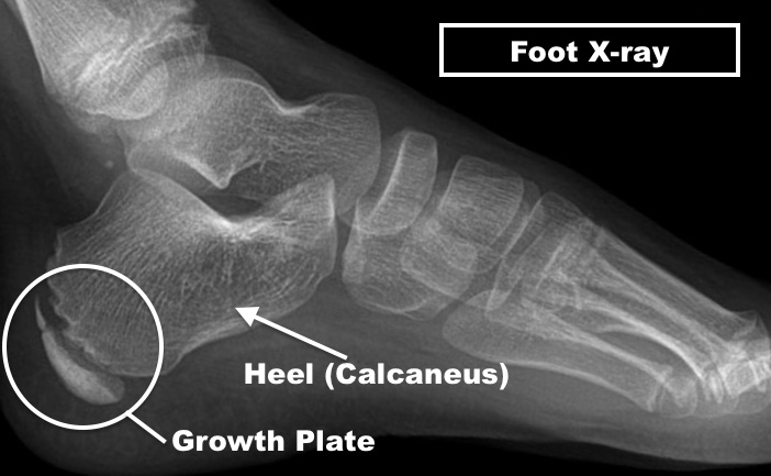 Sever's Disease (Heel Growth Plate Pain)