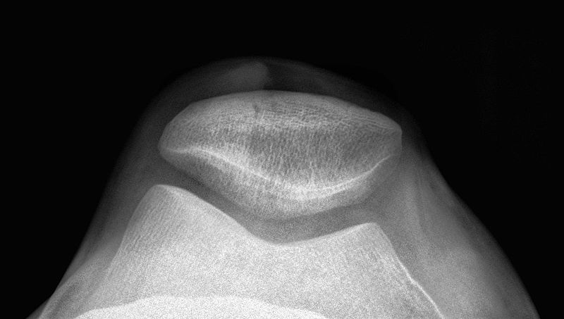 Patella (Knee Cap) Dislocation