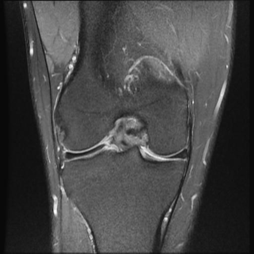 Case # 9 - Painless Knee Popping in Dancer