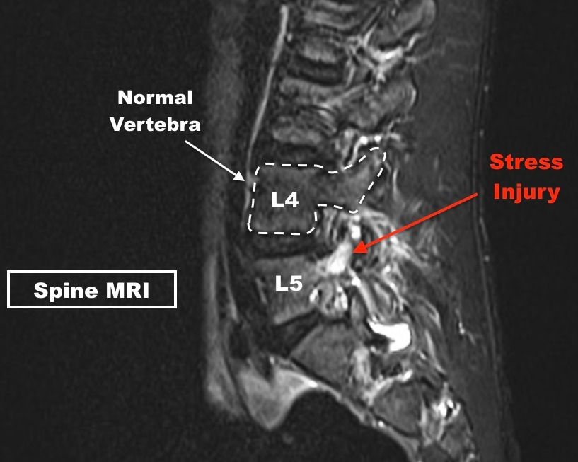 Stress Fracture of the Spine (Spondylolysis)