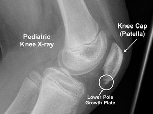 Sinding-Larsen-Johansson Syndrome (Knee)