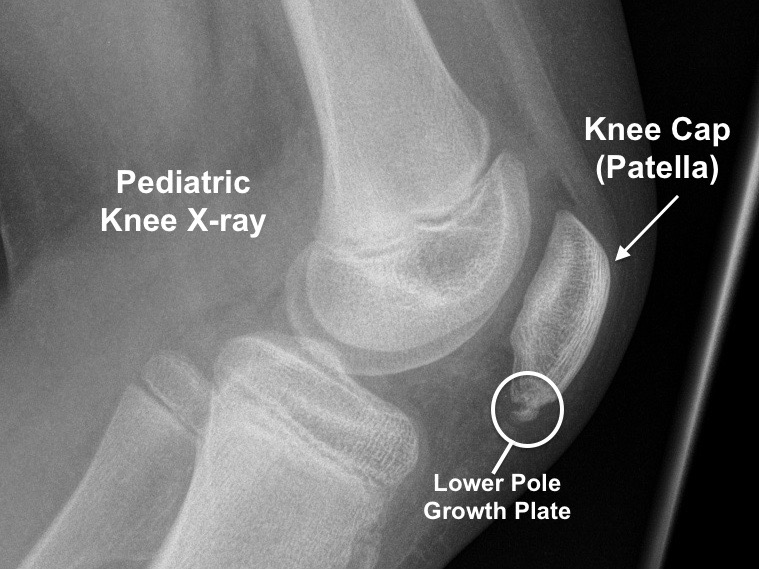 Sinding-Larsen-Johansson Syndrome (Knee)