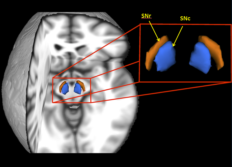 Research | PD MRI Lab