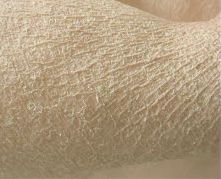 Icthyosis | Mundewadi Ayurvedic