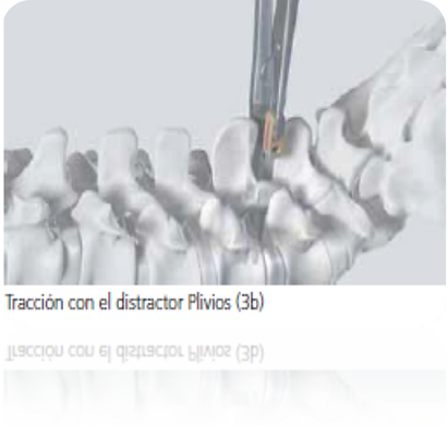 PROCEDIMIENTOS QUIRURGICOS EN COLUMNA | manual