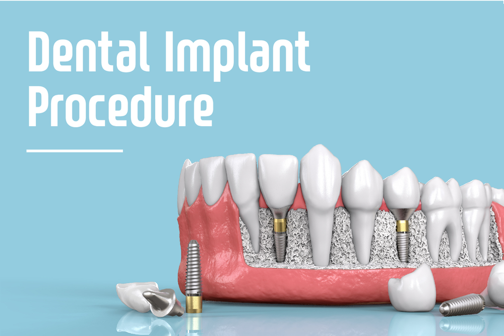 Step By Step: Two Stage Dental Implant Procedure in Beaverton ...