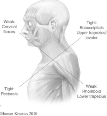 Why do I have Poor Posture?