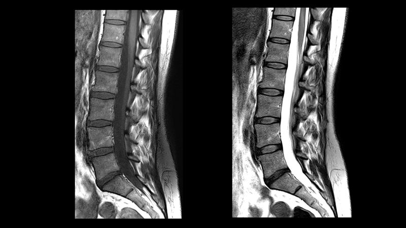 LUMBALGIA. Causas, tratamiento y prevención del dolor lumbar.