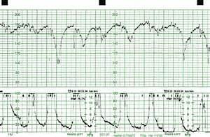 5. Tachysystole Algorithm | RMPI