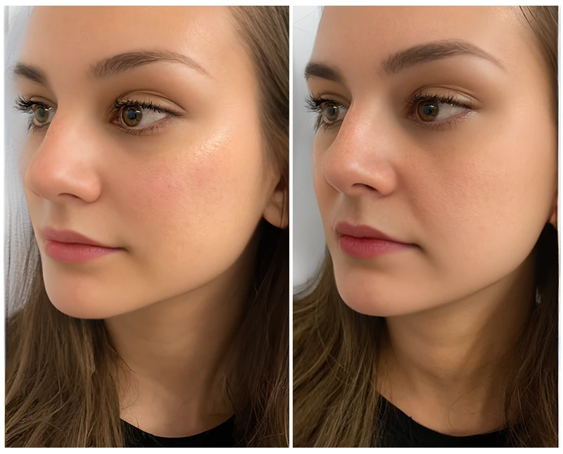 Everything about Cheek Filler Injections