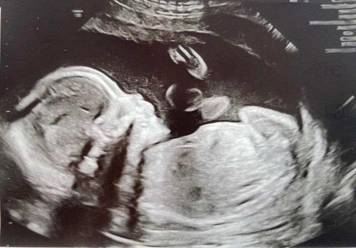 ECHOGRAPHIES DE GROSSESSE | PREGNANCY ULTRASOUNDS