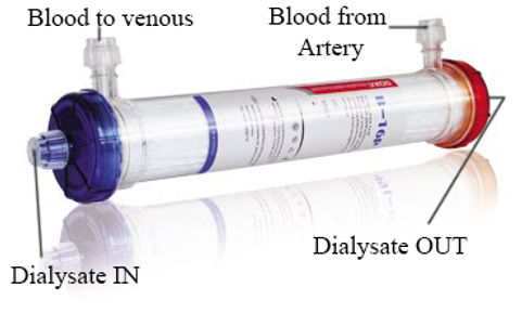 Hemodialysis | physiologypirate