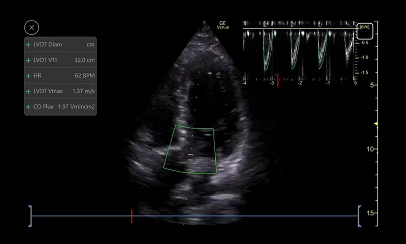 GE Ultrasound Feature Auto VTI | Cardiac output assessment with ...