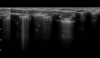 GE Ultrasound Feature Lung Sweep | Automatically scans the lungs ...