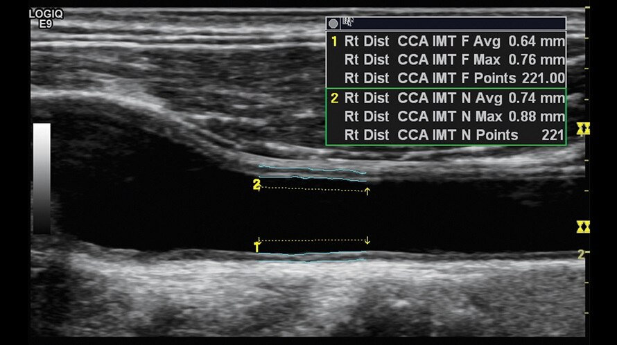 GE Ultrasound Feature Auto IMT | Measures intima-media thickness for ...