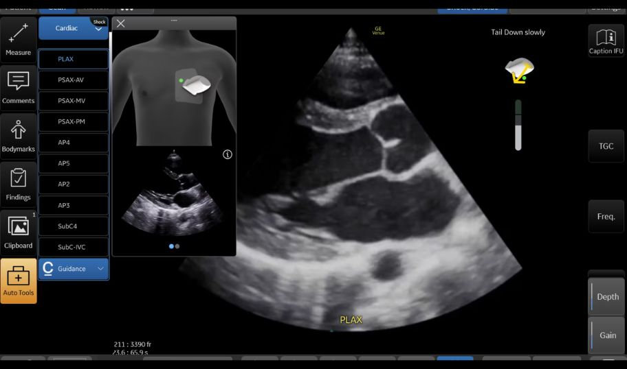 GE Ultrasound Feature Caption Guidance | Provides AI-based guidance for ...
