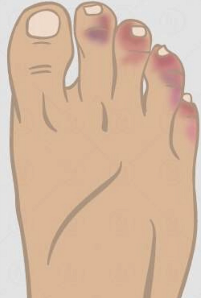 Cold Feet this Winter? It might be Chilblains