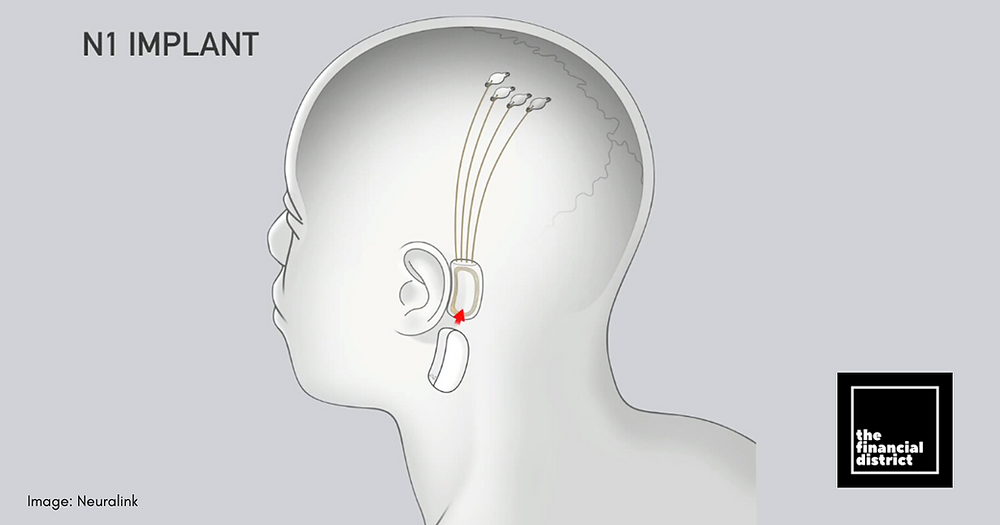 Interface Implants In Human Brains Will Be Done In 6 Months, Musk Brags