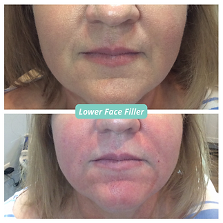 Dermal Filler - Lower Face | Signature Image