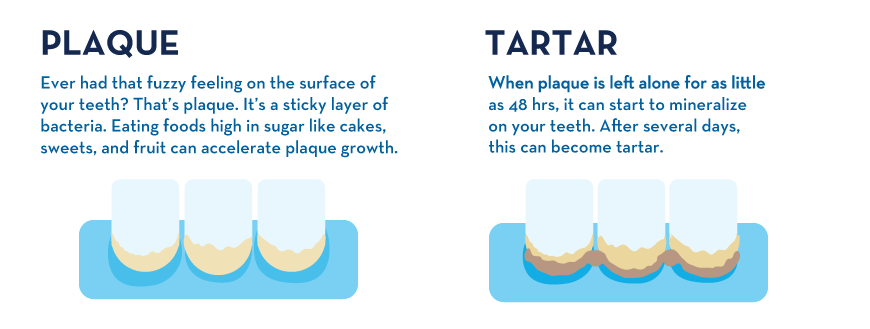 The difference between plaque and calculus