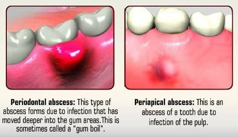What is a Dental Abscess?