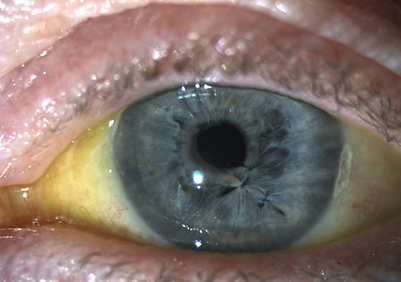 Iris disorders and reconstruction | South Coast Vision