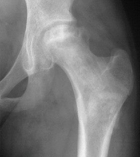 CS: Native Hip Dislocation | Orthorevision